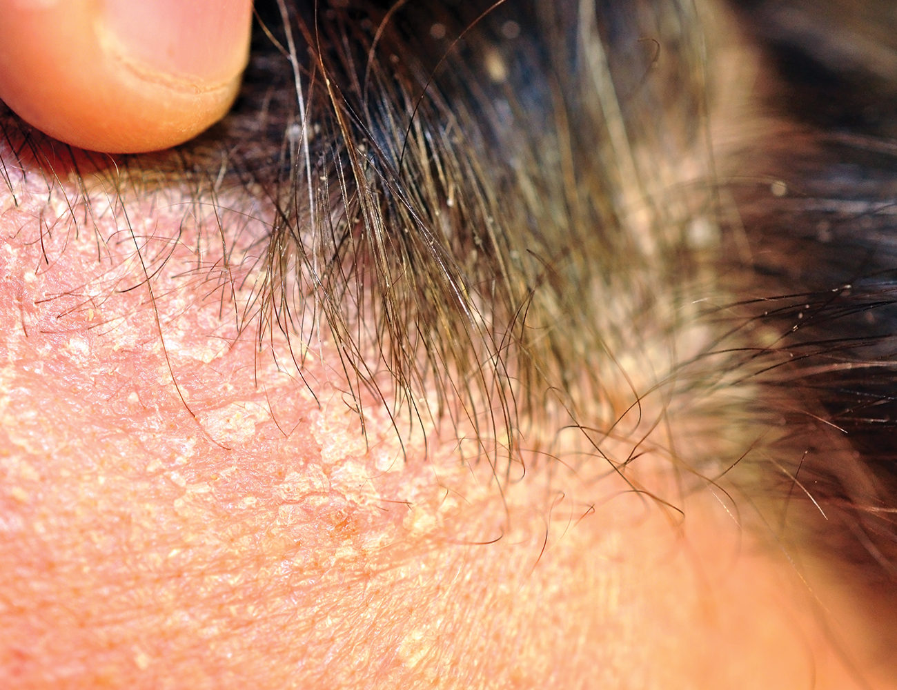 Seborrhoeic Dermatitis & Dandruff: Causes and Solutions - Bioxcin